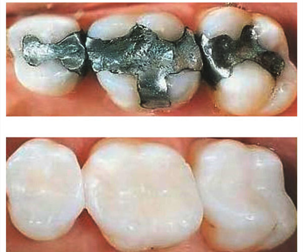 Tooth Coloured Fillings - Dr Bari Dental Clinic